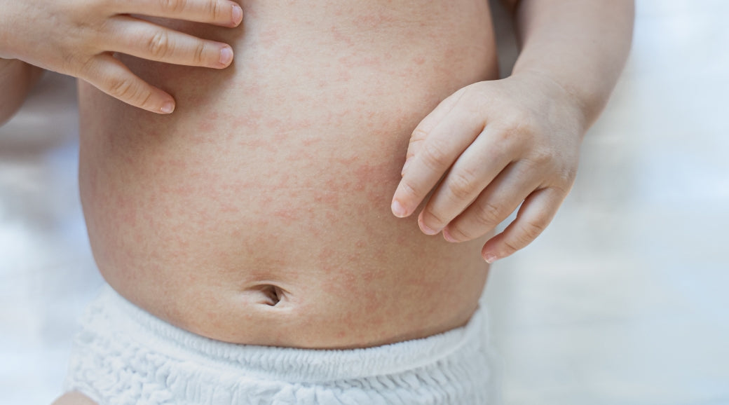 Our skin story | Triumphing over toddler eczema – Dermatology M Store